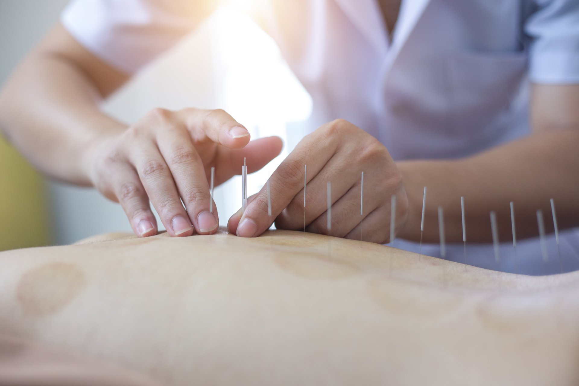 Acupuncture Treatment | Farmington, MO | Harmony Chiropractic LLC