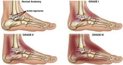 Physical Therapist's Guide to Ankle Sprain
