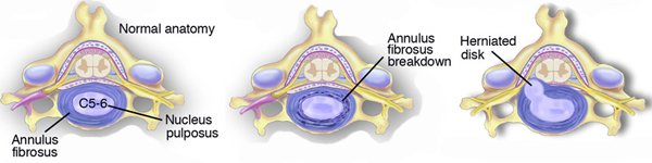 Physical Therapist's Guide to Herniated Disc