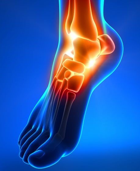 Physical Therapist's Guide to Ankle Fracture
