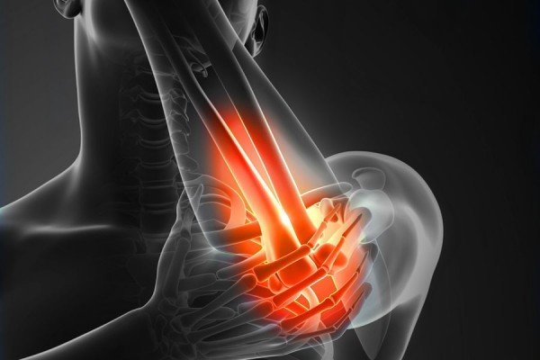Physical Therapist's Guide to Golfer's Elbow (Medial Epicondylitis)