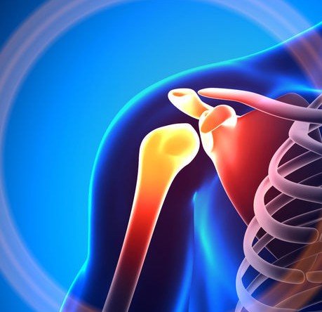 Physical Therapist's Guide to Total Shoulder Replacement (Arthroplasty)