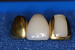 Gold Teeth Baton Rouge | Baker, LA