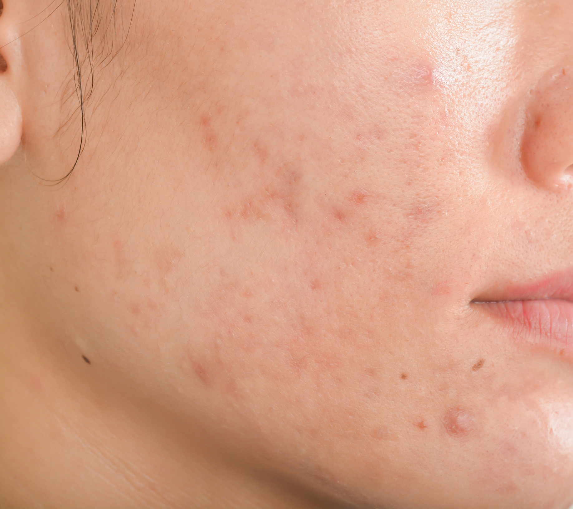 Inflammatory Versus Non Inflammatory Acne Inflammatory Versus Non Inflammatory Acne