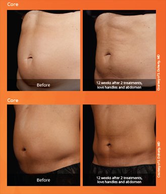 Sculpsure | Wellington, Florida | Dermatology Center of Wellington
