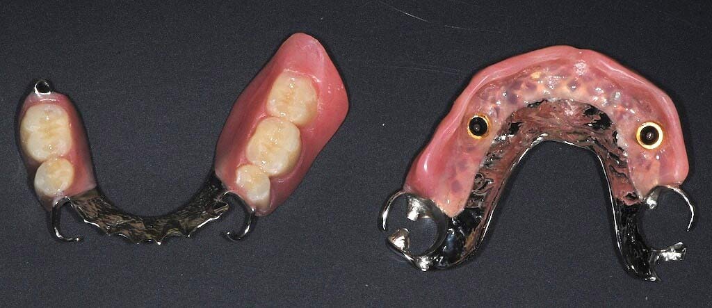 Removable Partial Dentures - Newport News, VA - Tidewater Prostho