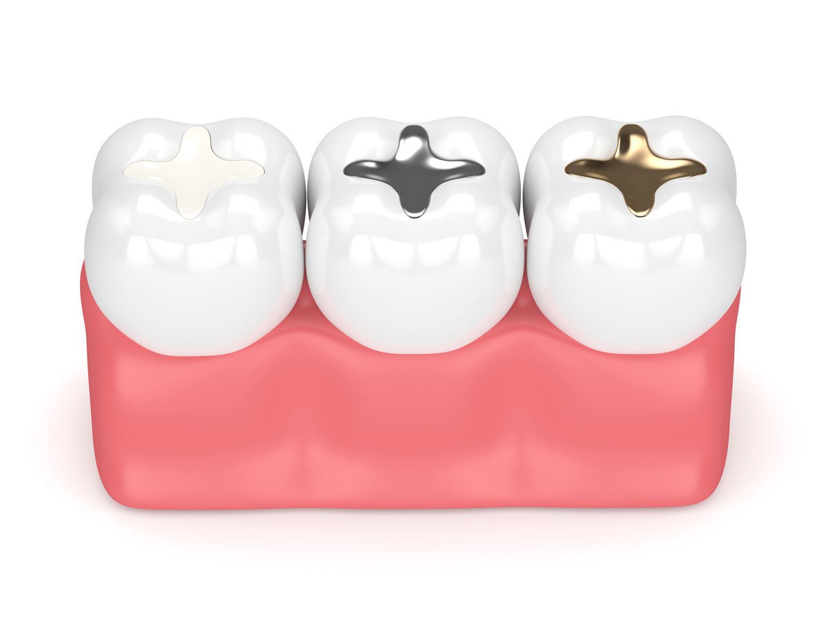 Tooth-Colored Fillings in Tukwila and Near Renton, WA