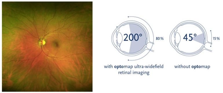 OPTOS Retinal Exam