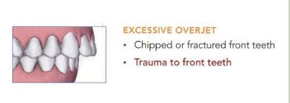 Invisalign Orthodontics - Tampa, FL - The Hyde Park Center For ...