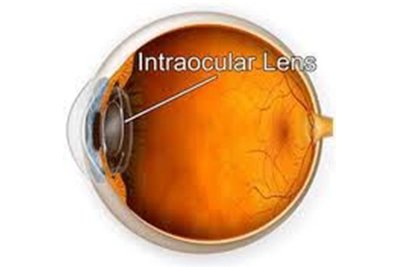 Refractive Lens Exchange | Hummel Eye Associates | OK City