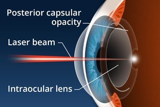 YAG Laser Capsulotomy Surgery | Hummel | Oklahoma City, OK