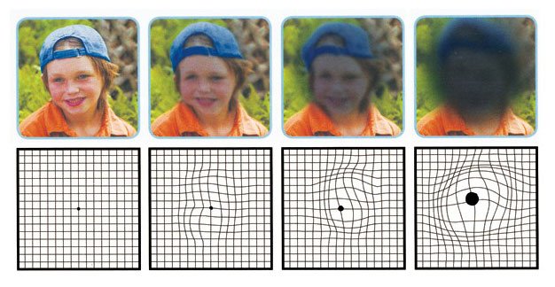 Macular Degeneration | Hummel Eye Associates | Oklahoma City