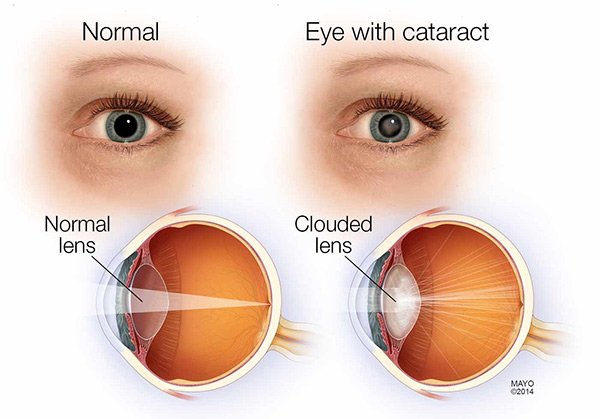 Cataracts | Hummel Eye Associates | Oklahoma City, Oklahoma
