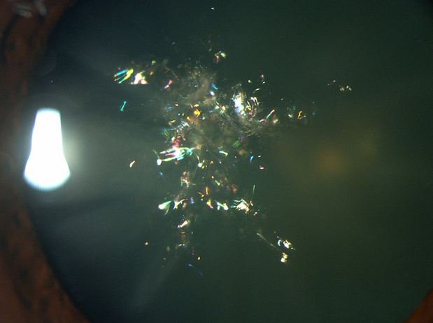 Oh Christmas Tree...Cataract?